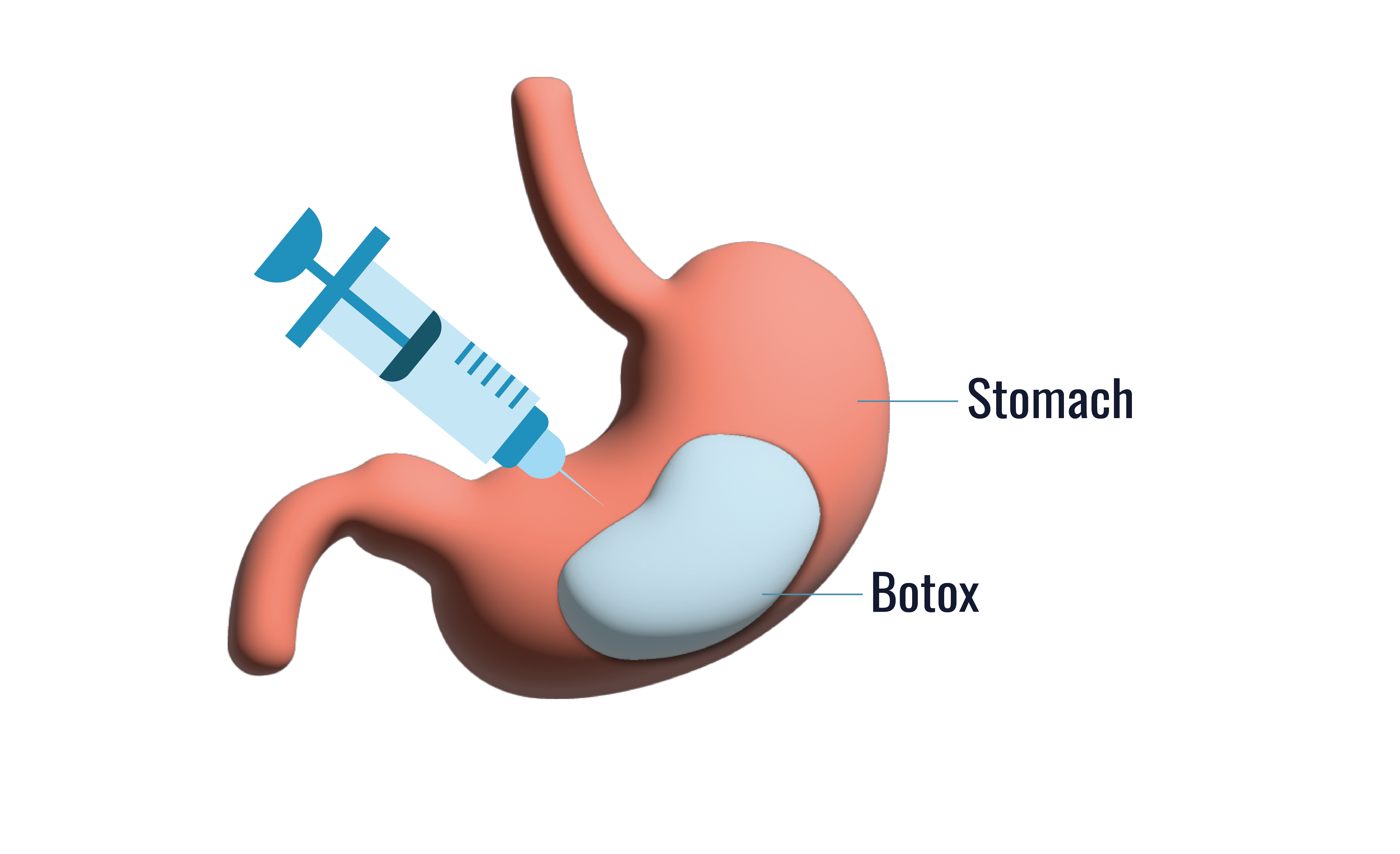 Stomach Botox – Deluxe Clinic Istanbul